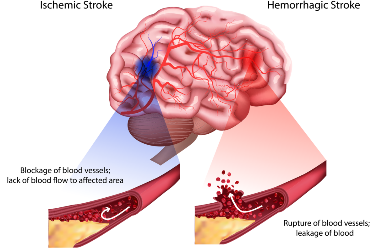 Cerebrovascular Accident (CVA) - Signature Health Services