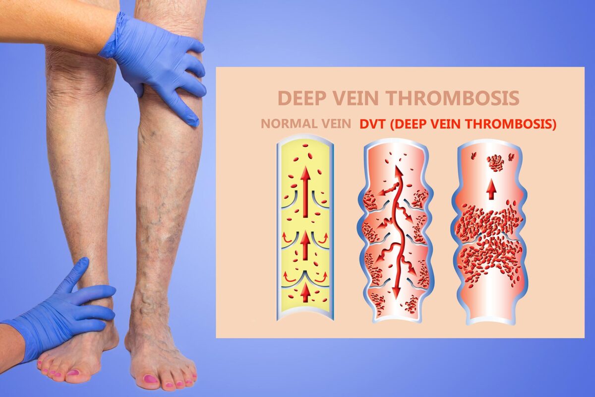 Deep Vein Thrombosis (DVT) Prevention Awareness Month - Signature ...