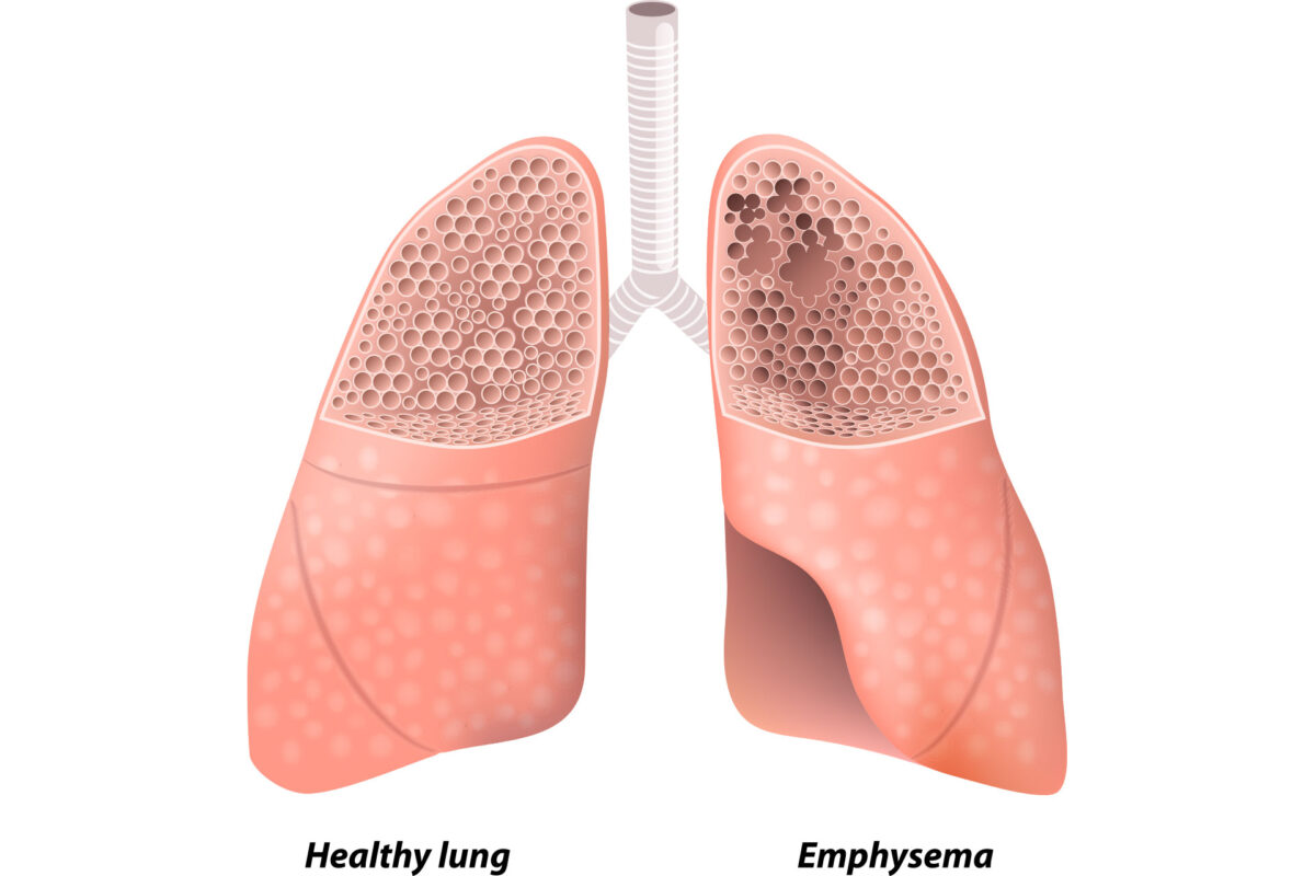 Emphysema - Signature Health Services