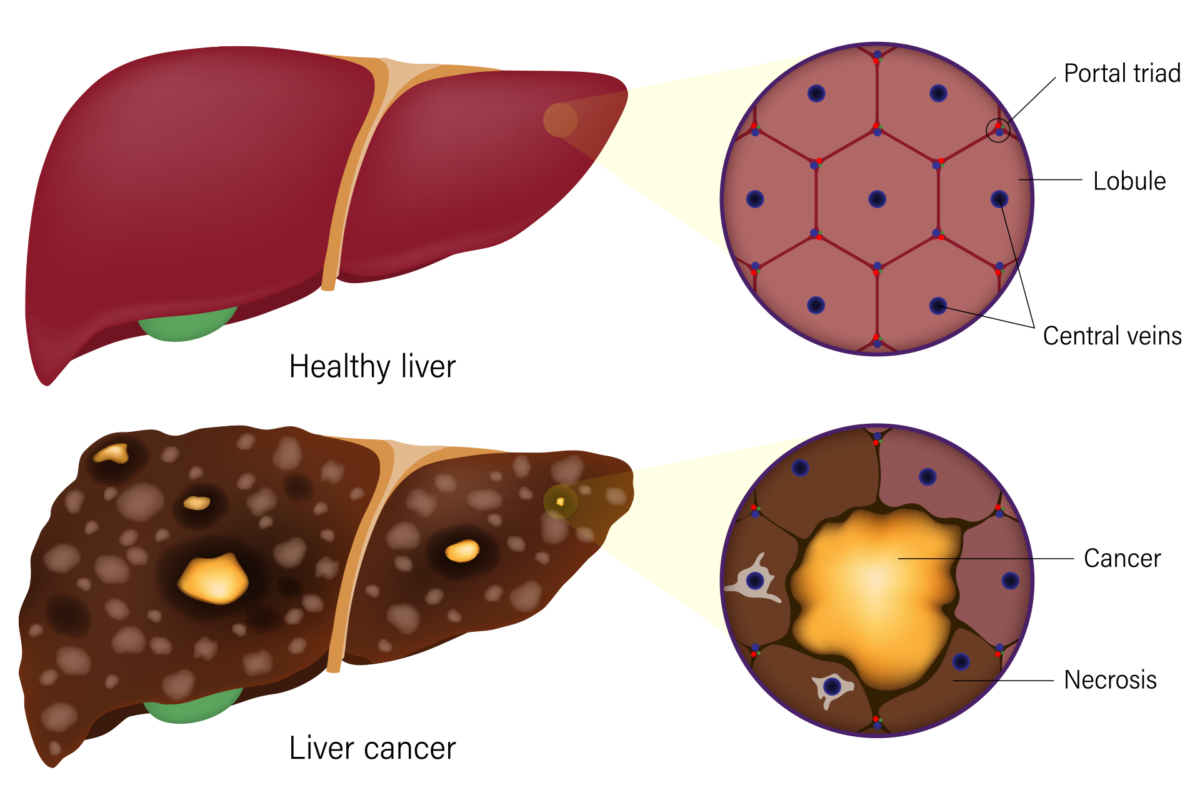 Liver Cancer Awareness Month - Signature Health Services