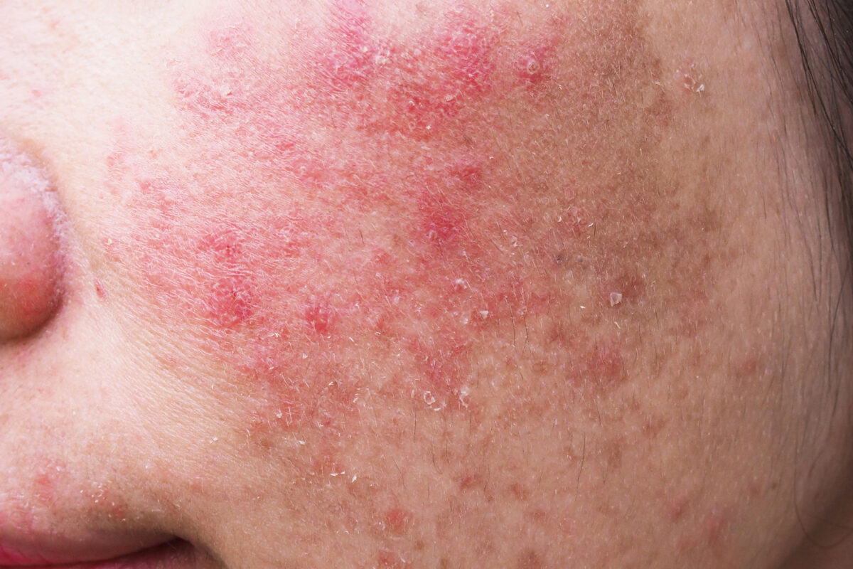 Lupus Awareness Month - Signature Health Services