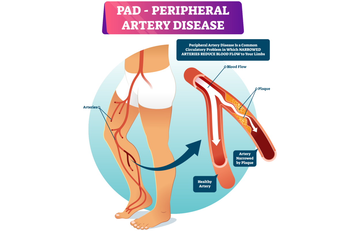 Peripheral Arterial Disease (PAD) - Signature Health Services