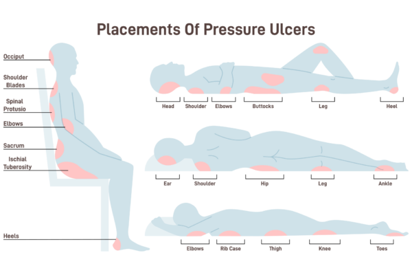 Pressure Ulcers/Bedsores - Signature Health Services