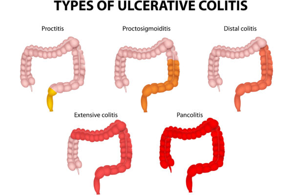 Colitis - Signature Health Services