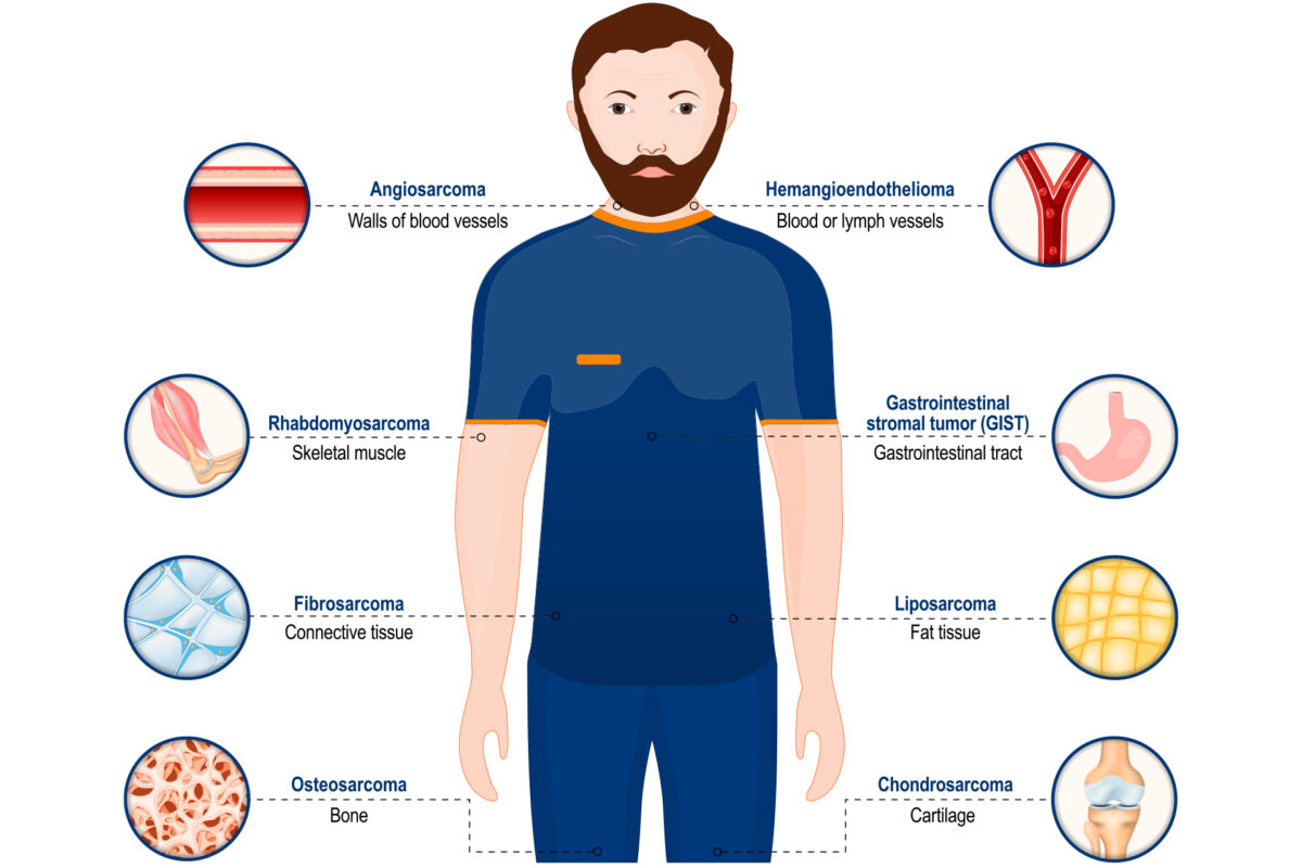 Sarcoma Cancer Awareness Month - Signature Health Services