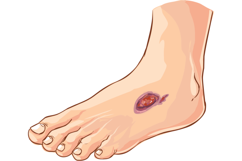 Arterial Ulcers - Signature Health Services